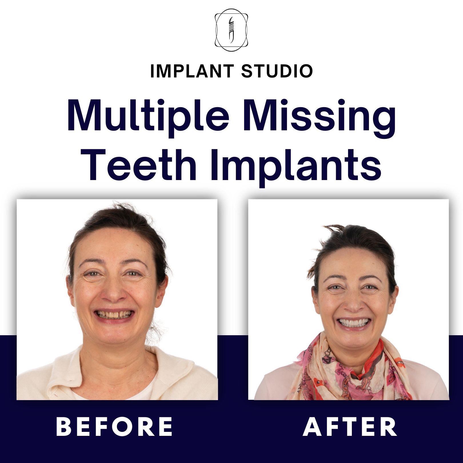 Multiple Missing Teeth Dental Implants in Geneva | Implant Studio